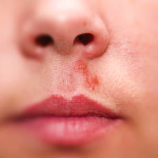 Jak se tvoří opar a čím ho léčit? - Chytrá žena